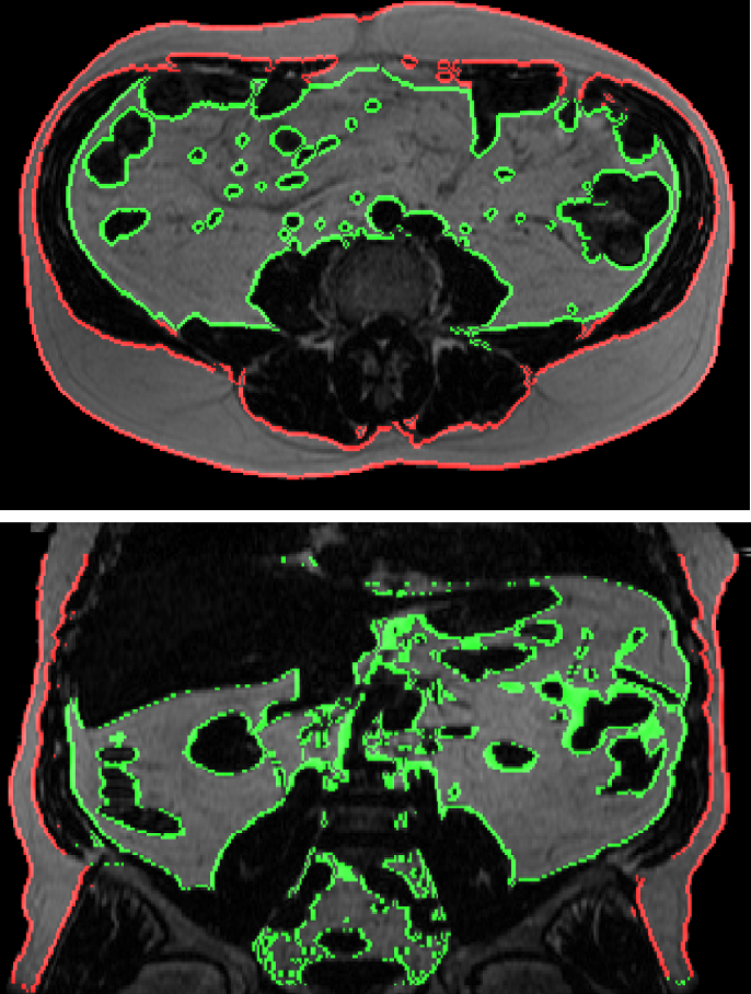 Figure 1. Segmentation of visceral fat (red) andsubcutaneous fat (green ...