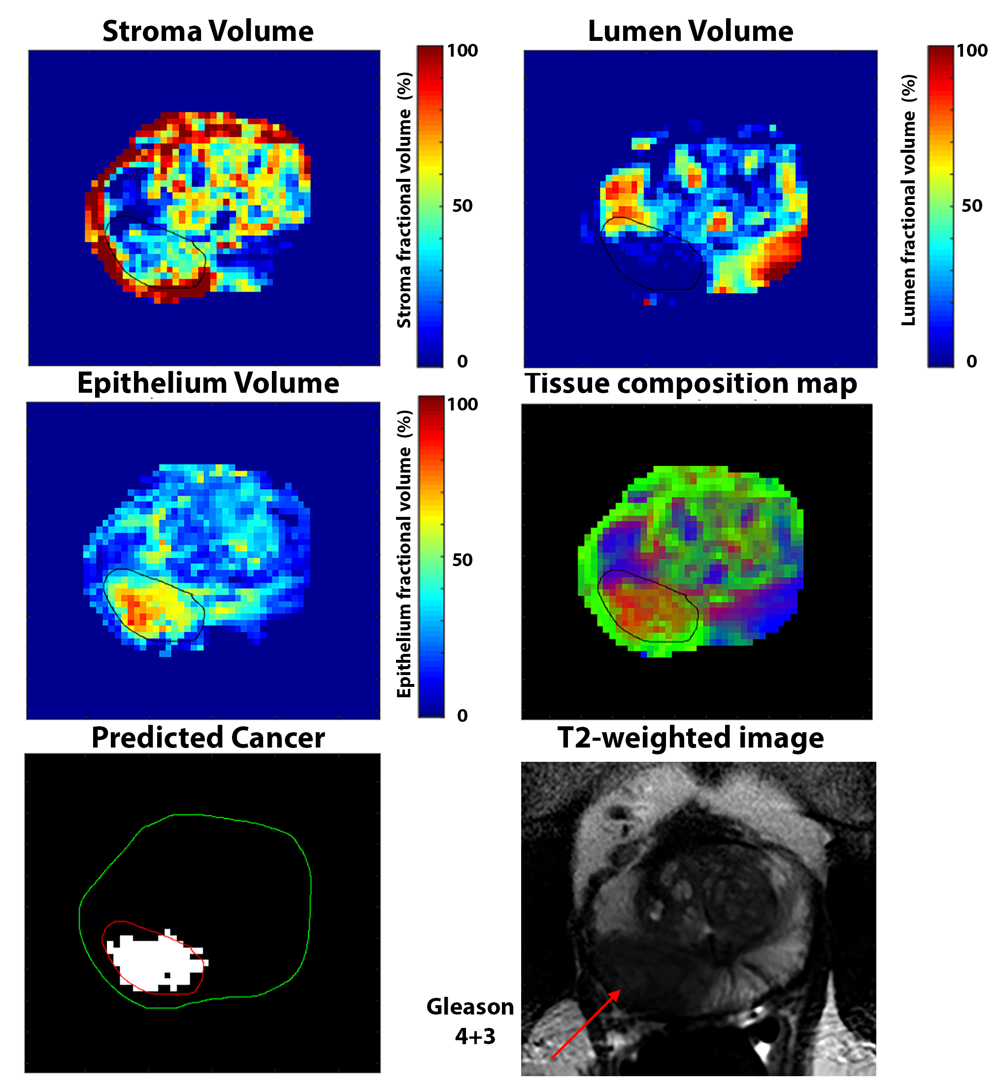 Table1: Comparison of HM-MRI metrics measured using Philips Achieva and ...