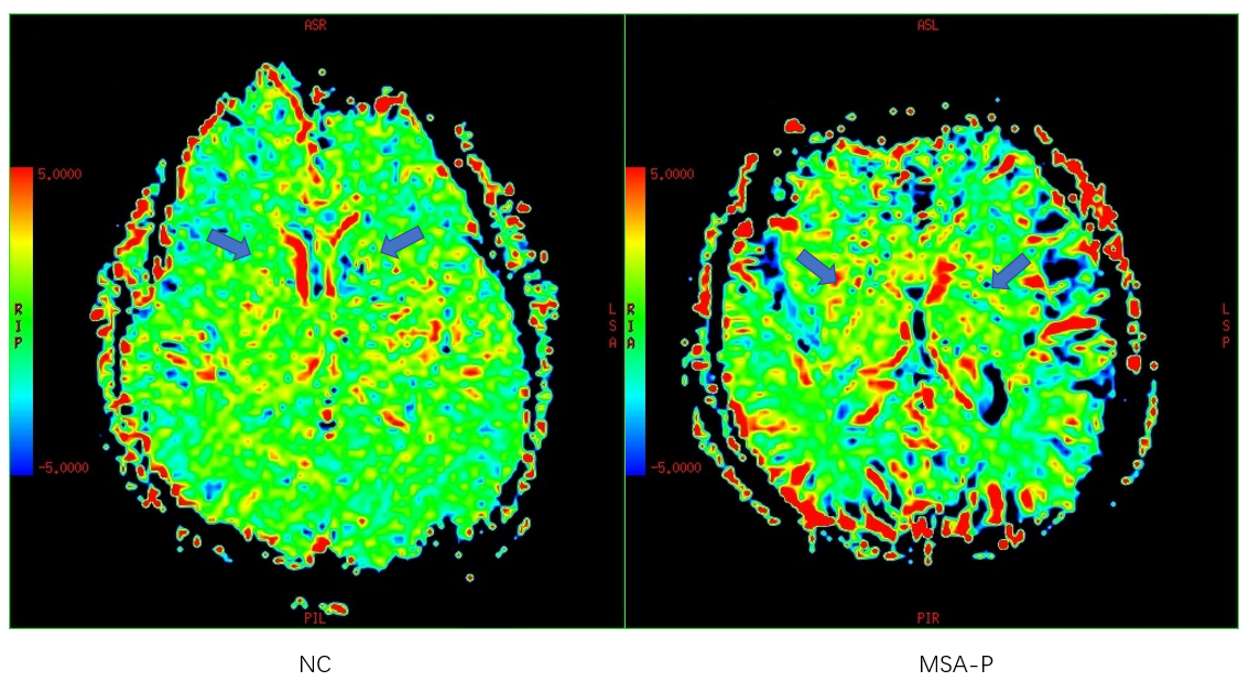 Figure 2:The comparison of MSA-P patients and normal controls.