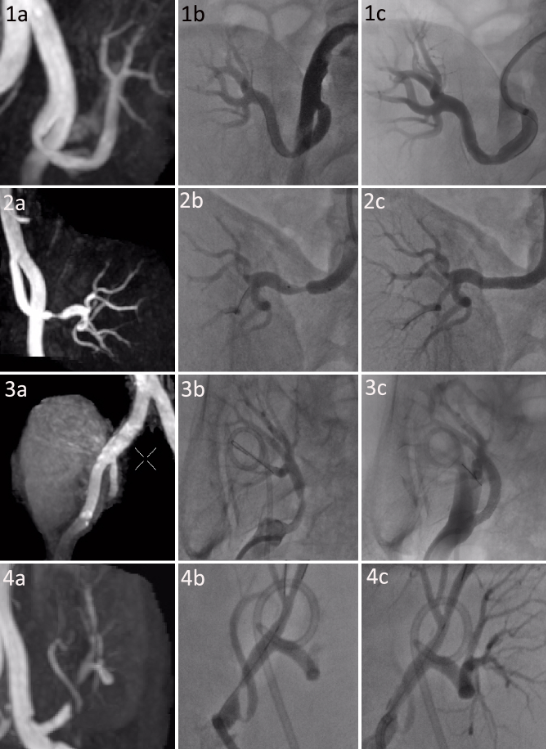 Fig 1: 1-4 Four patients with ages of 60, 48, 50, 36 respectively:
