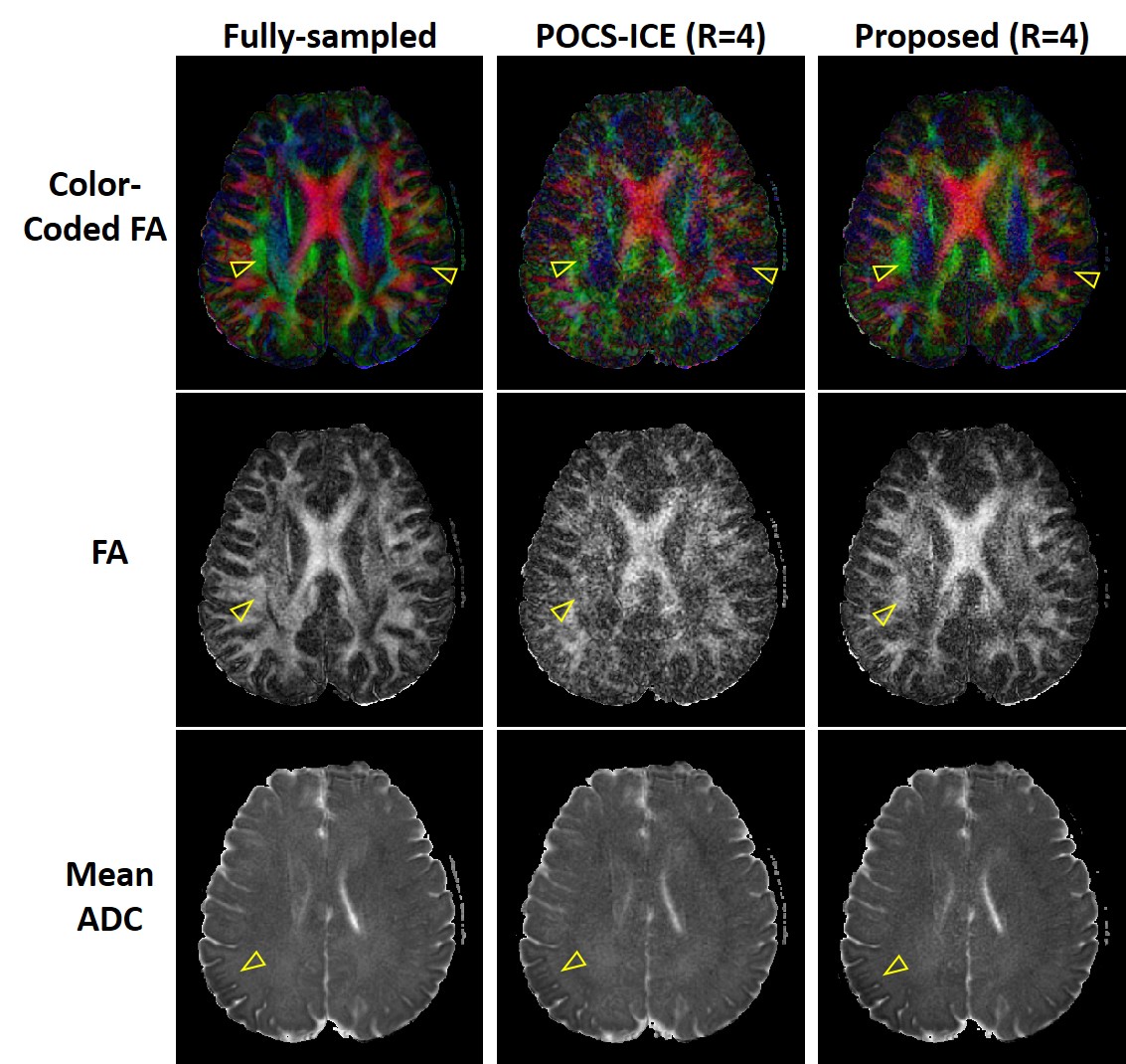 We propose a novel joint calibrationless reconstruction for ...