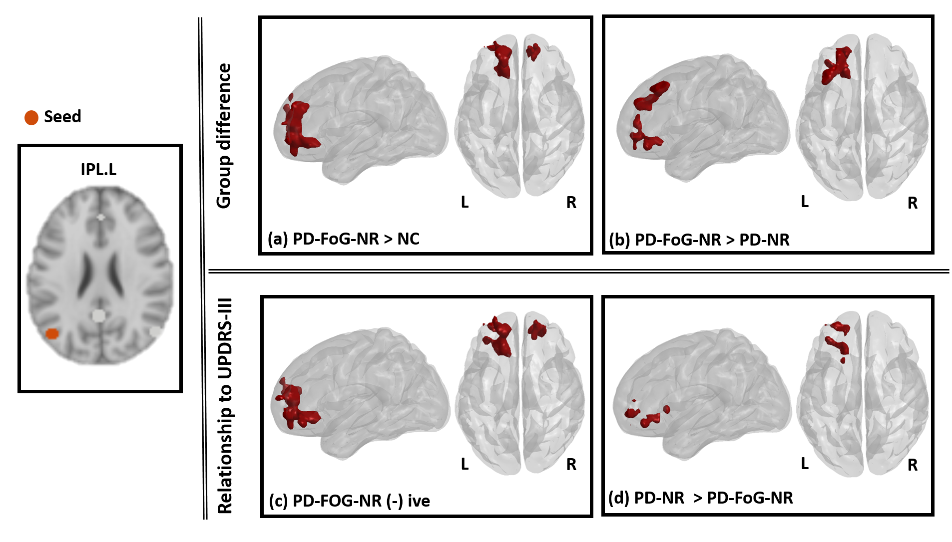 The results of our pilot study demonstrates that Parkinson’s ...