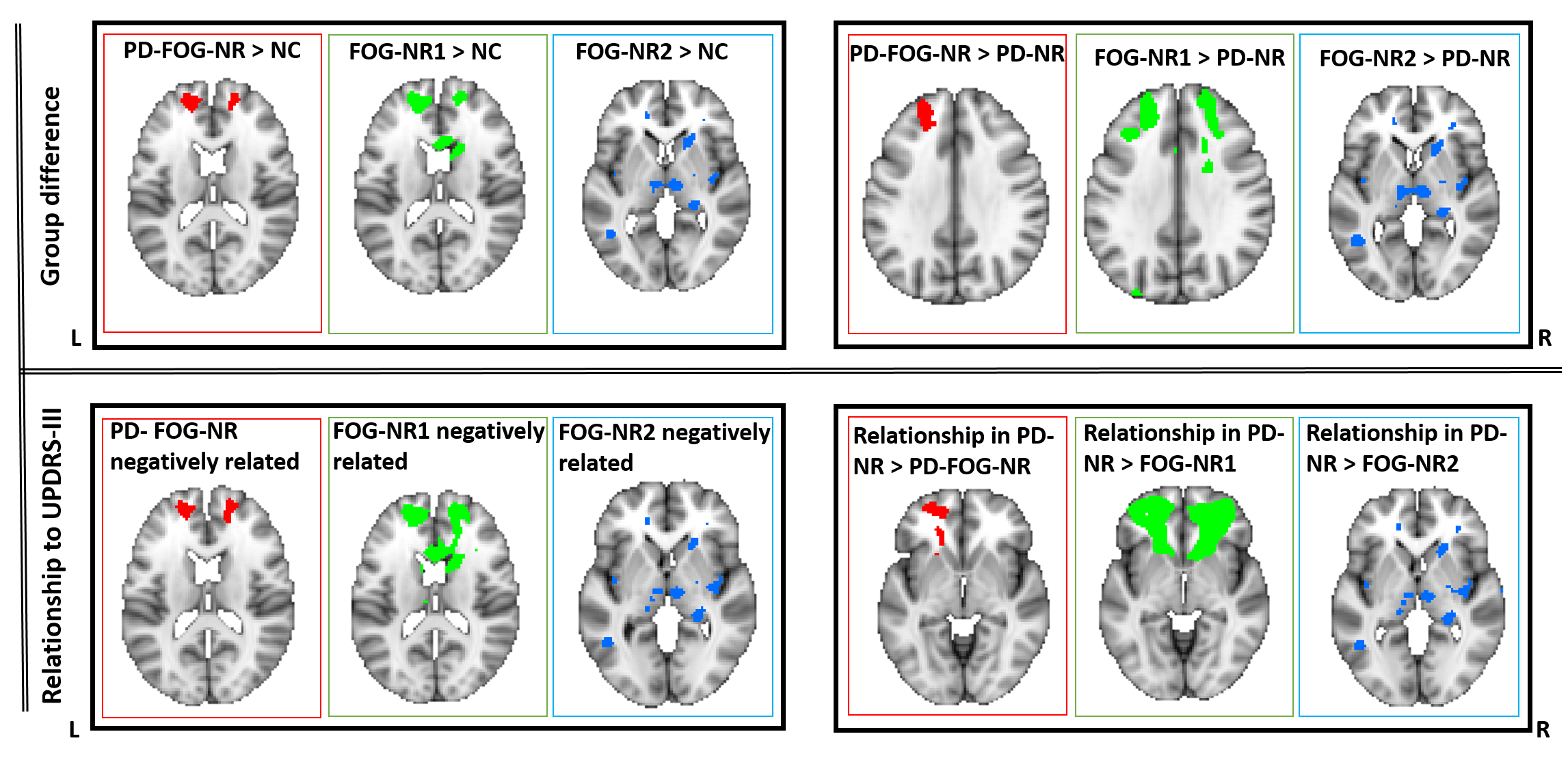 Default mode network connectivity differences in levodopa responsive ...