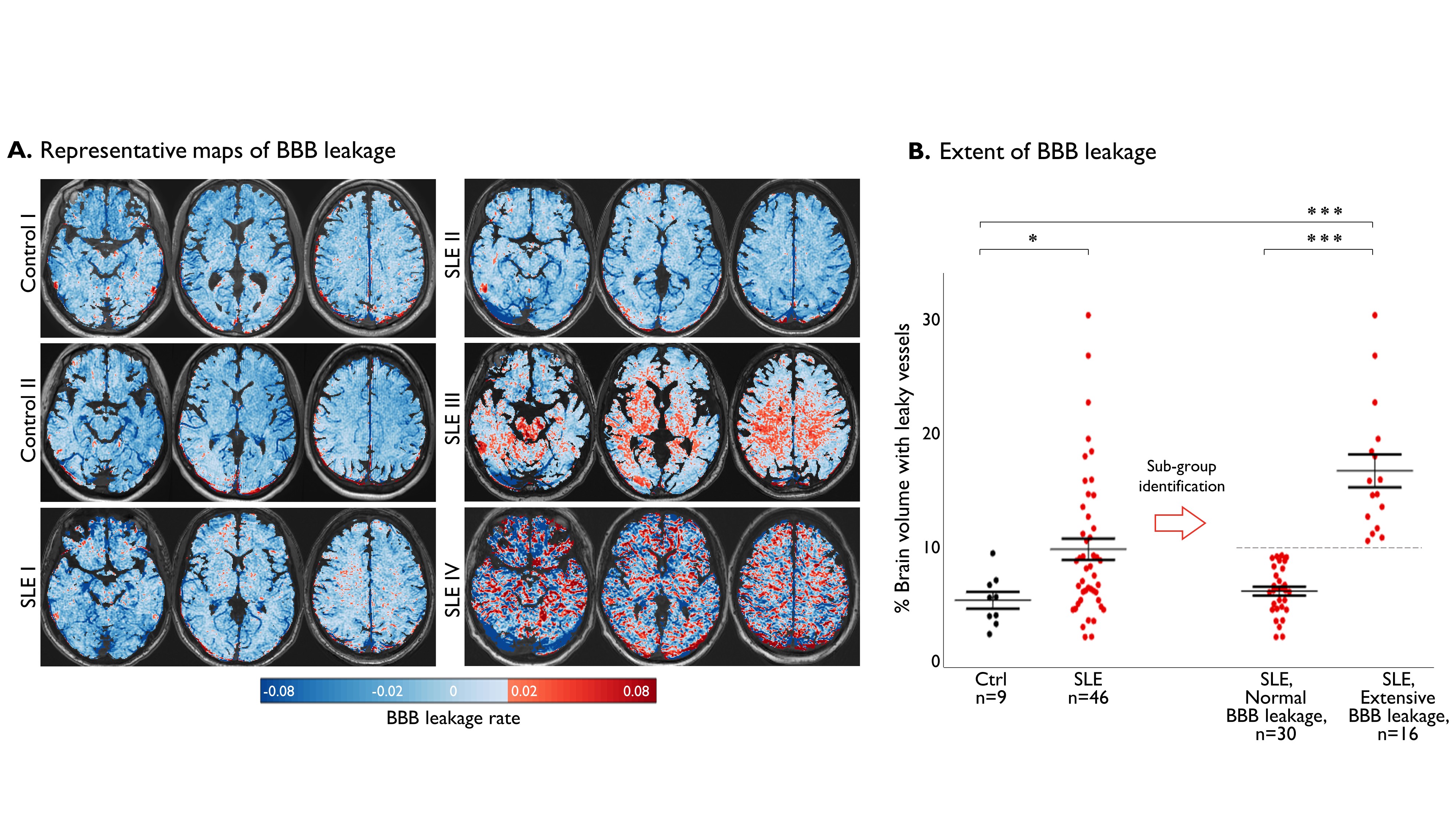 Extensive blood-brain barrier leakage in systemic lupus erythematosusis ...