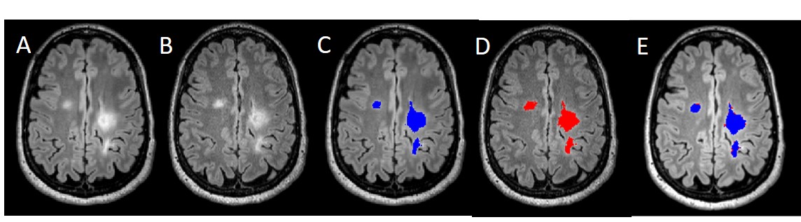 Table 1. Acquisition parameters for standard andWave SPACE-FLAIR sequences