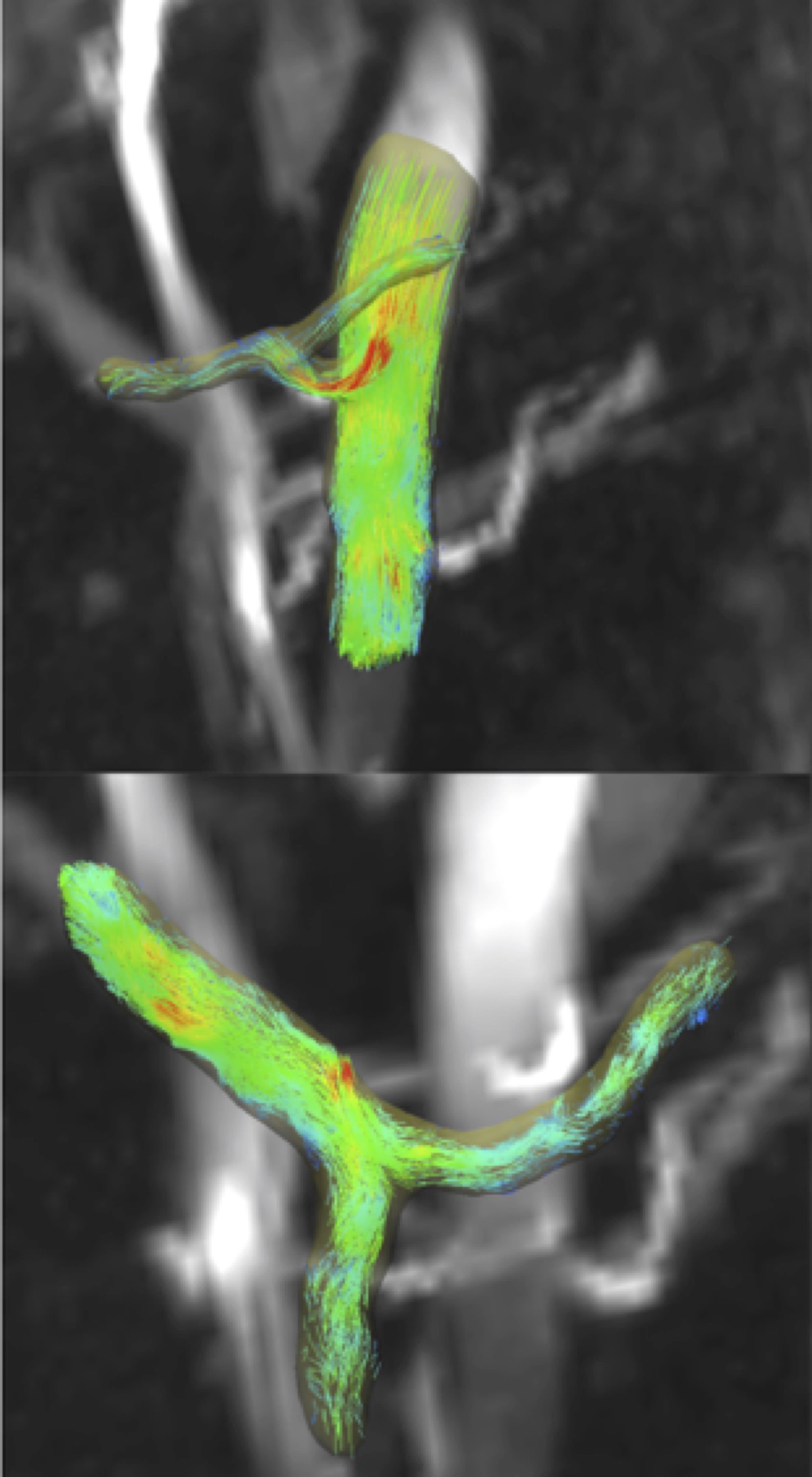 Peak velocity in the celiac trunk measured by 4D flow MRI significantly ...