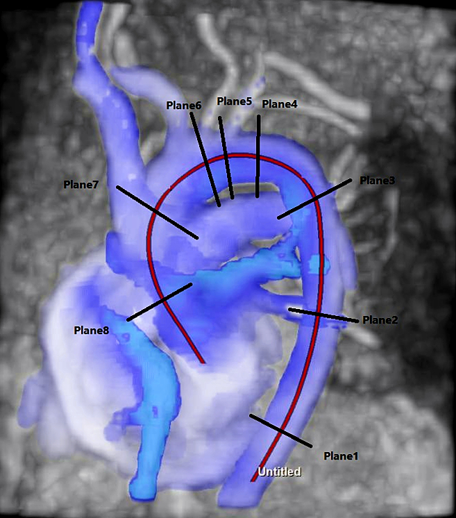 Hemodynamic Characteristics in Patients with Plaques in Thoracic Aorta ...