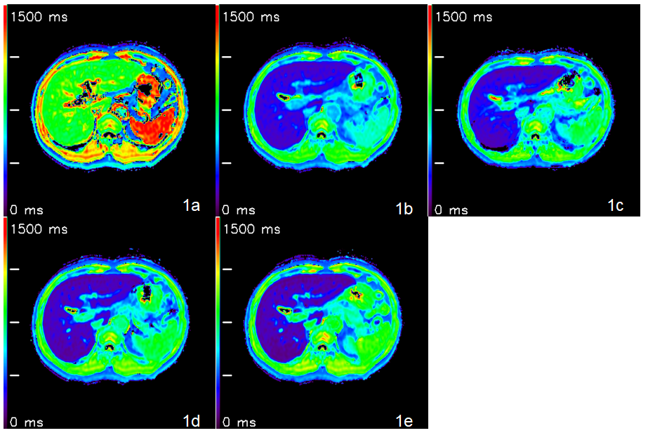 Our study showed that Gd-EOB-DTPA-enhanced T1mapping MRI is helpful for ...
