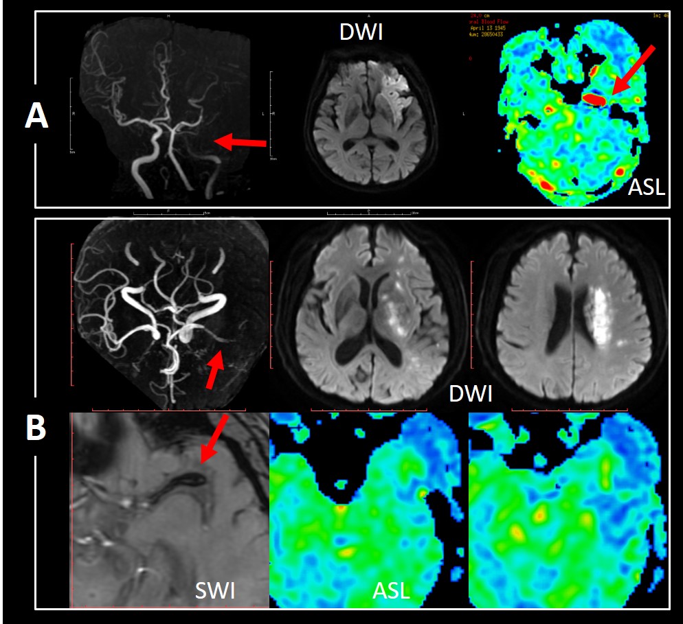 Bright Vessel Appearance on Arterial Spin Labeling MRI: Beyond ...