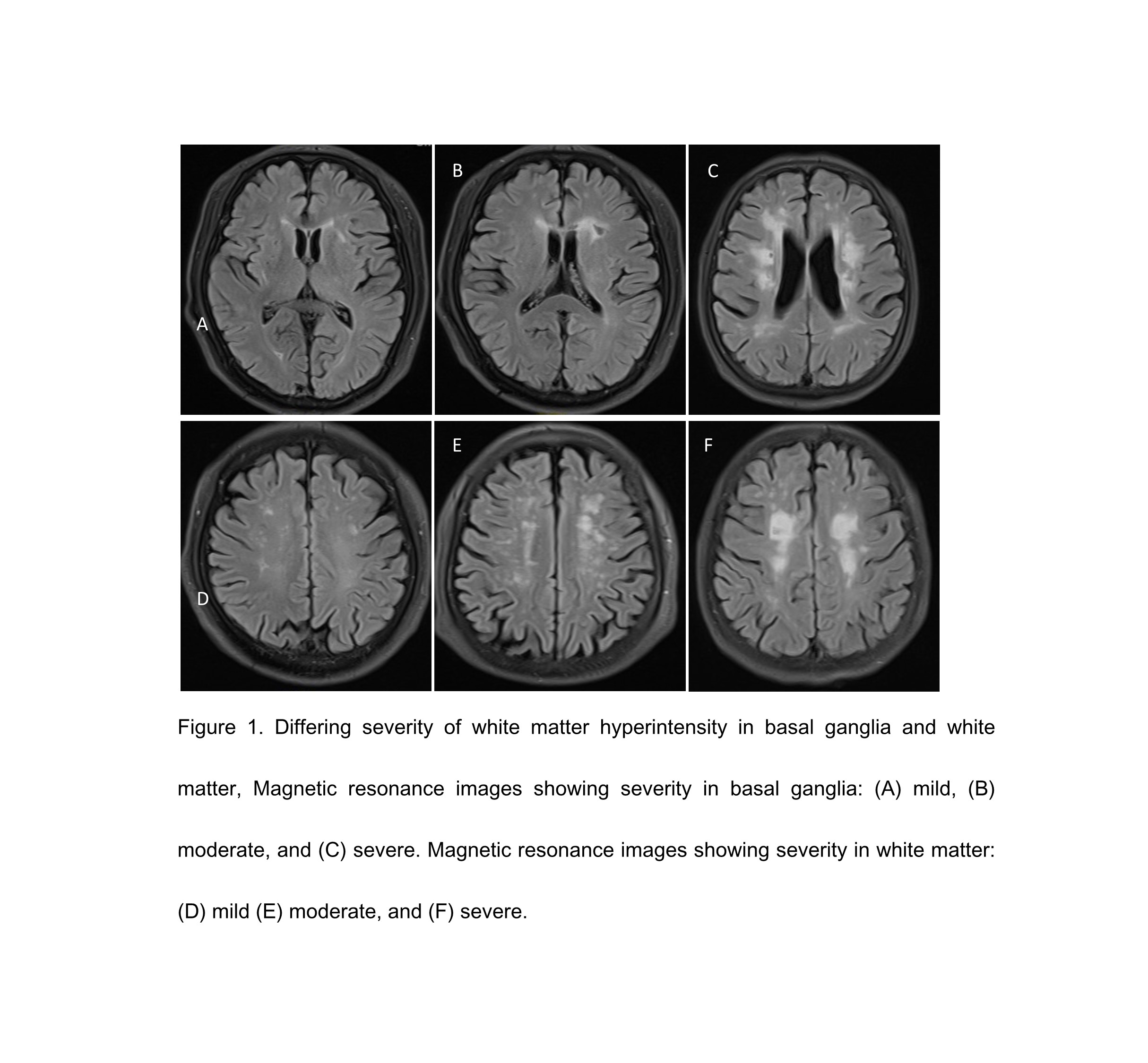 DKI technique can be used to probe themicrostructural changes of ...