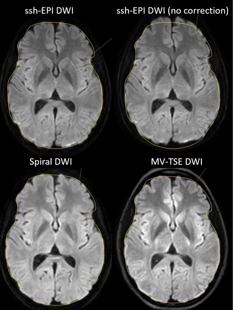 Figure 1: Comparison of different DWI acquisitions, b1000 images shown ...
