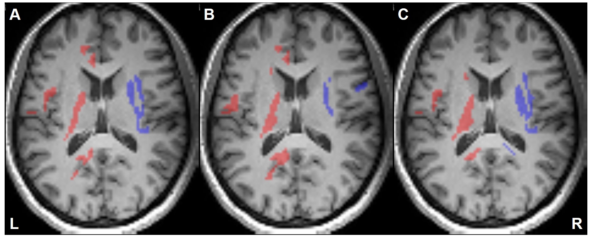 The voxels withsignificant laterality in the GFA (A), NQA (B) and FA (C ...