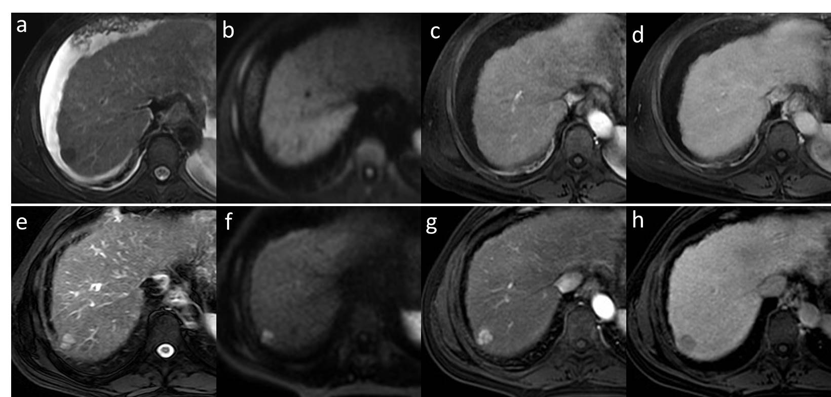 在肝硬化中使用LI-RADS v2018进行MRI检查，发现LR-2，LR-3和LR-4病变具有不同的自然结局，随着类别的增加，LI-RADS ...