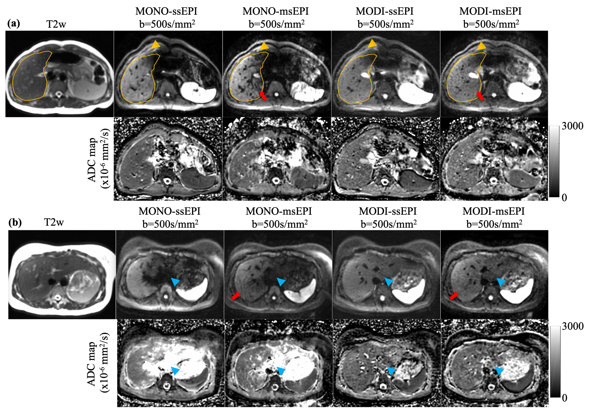 Combining optimized motion compensated diffusionwaveforms and multi ...