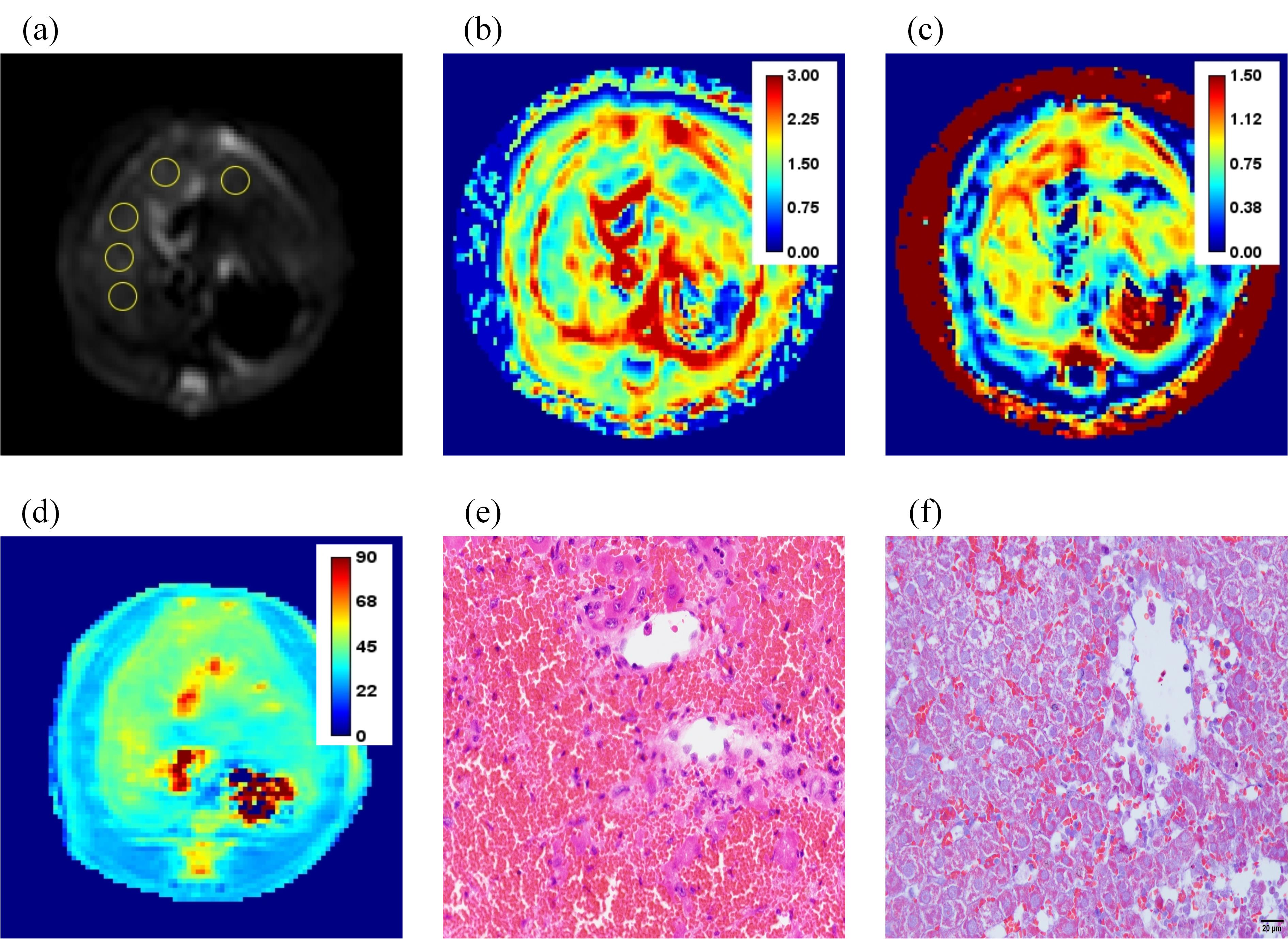 T1rho was a feasible tool in detection of SOSprogression, and there are ...