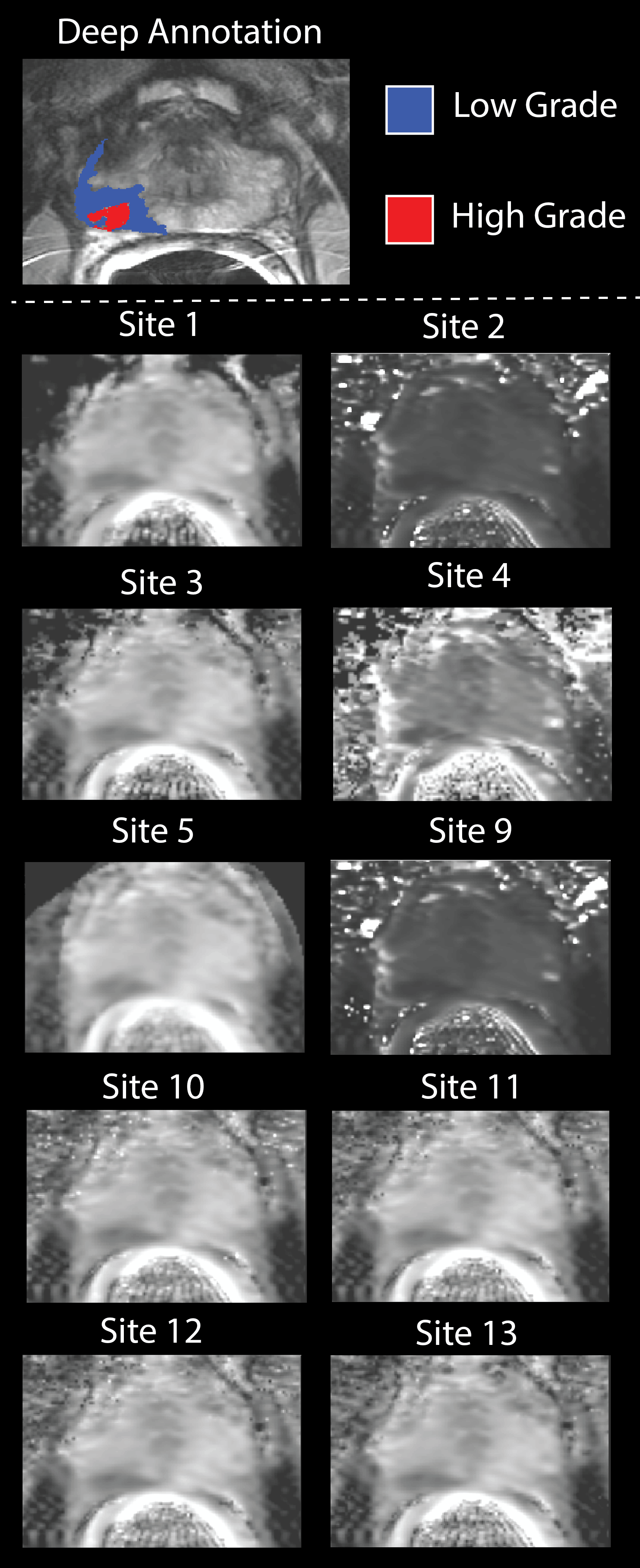 Figure 1. Top: Pathologist annotations overlaid onaxial T2. High grade ...