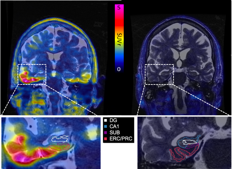 Tau-PET SUV mapped on to coronal T2 MR image with hippocampal subfields ...