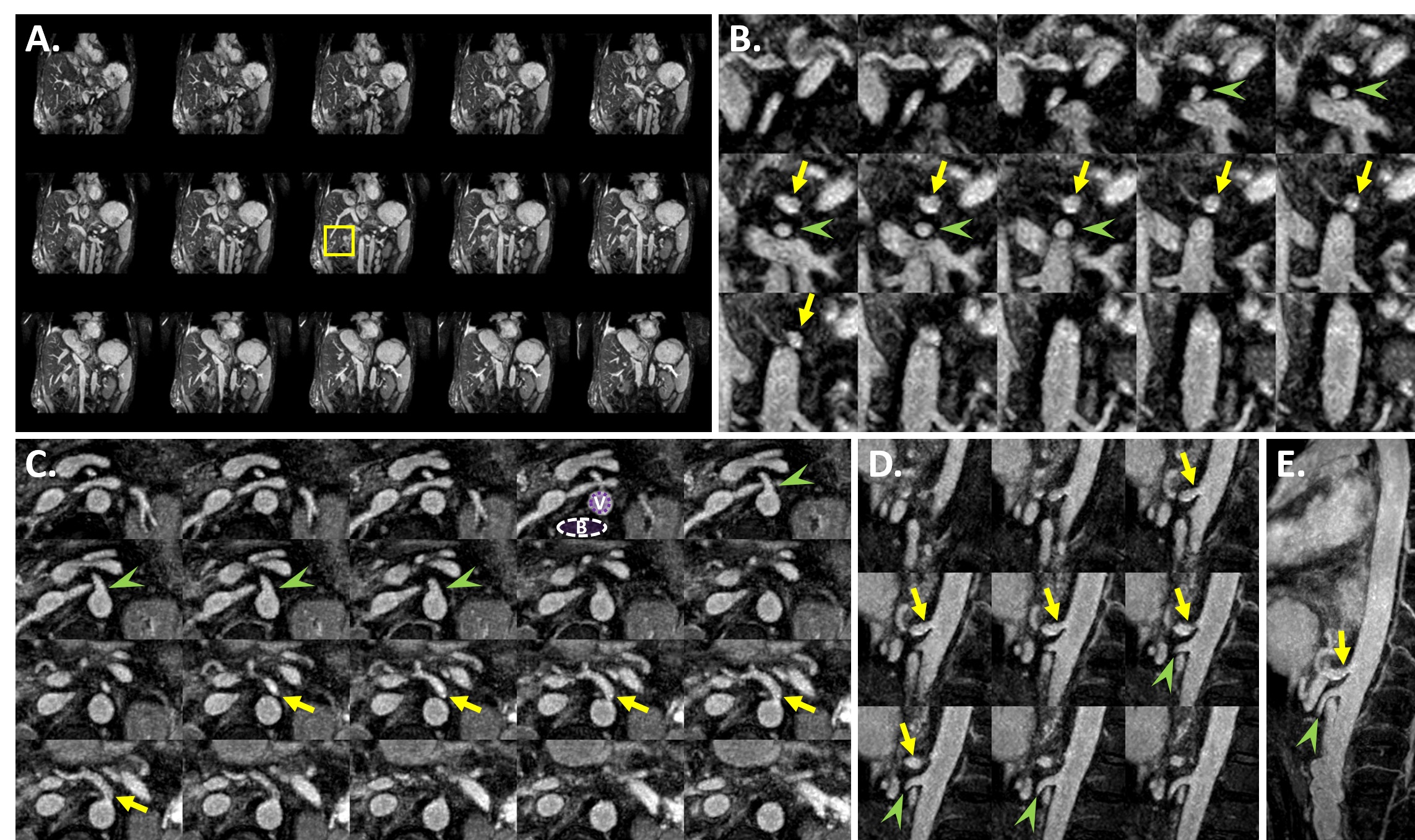 Non-Contrast-Enhanced MR Angiography of The Celiac Trunk Using 3D ...