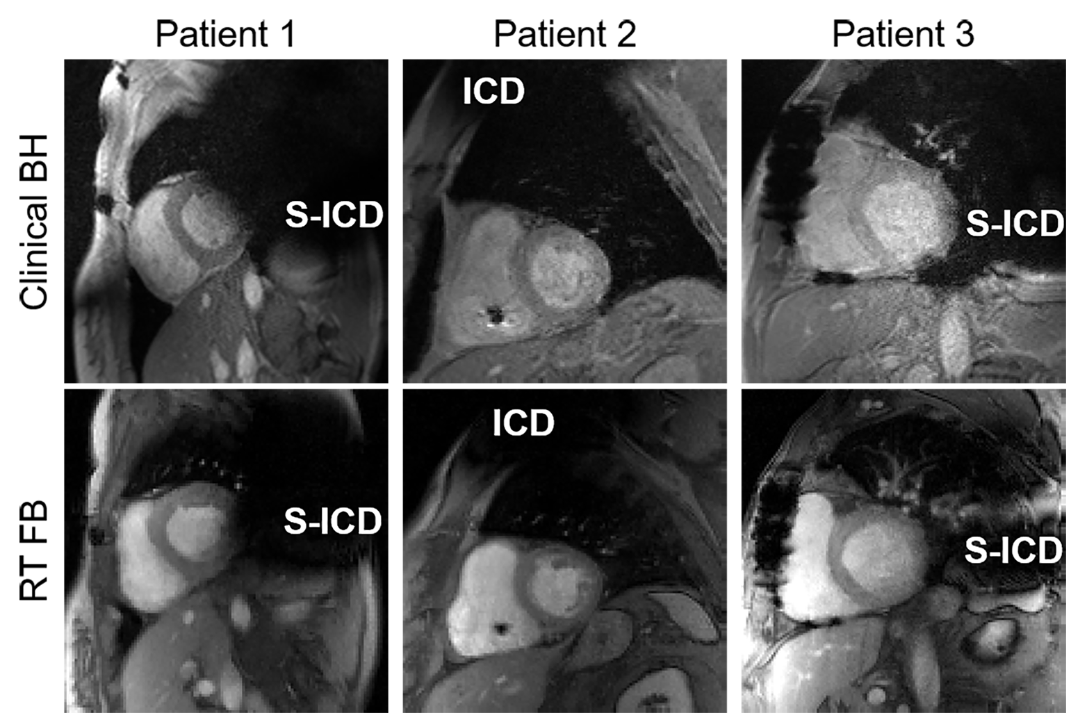 16-fold accelerated real-time free-breathing cardiac cine MRI in ...