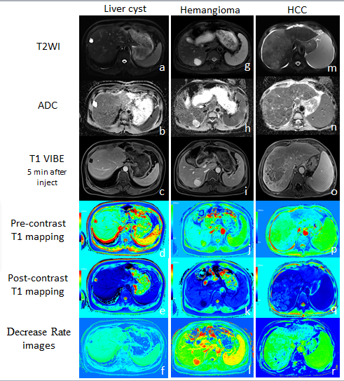 T1-mapping technology for differential diagnosis of hepatic cyst ...