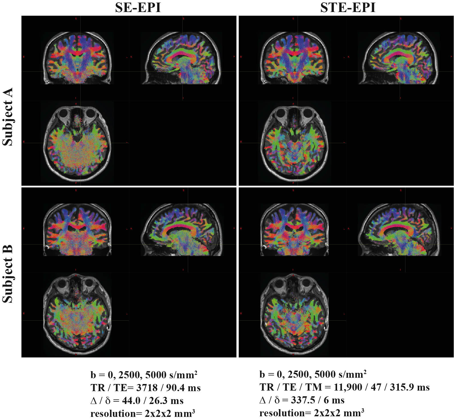On clinical scanners, high b-value diffusionstudies using SE-EPI suffer ...
