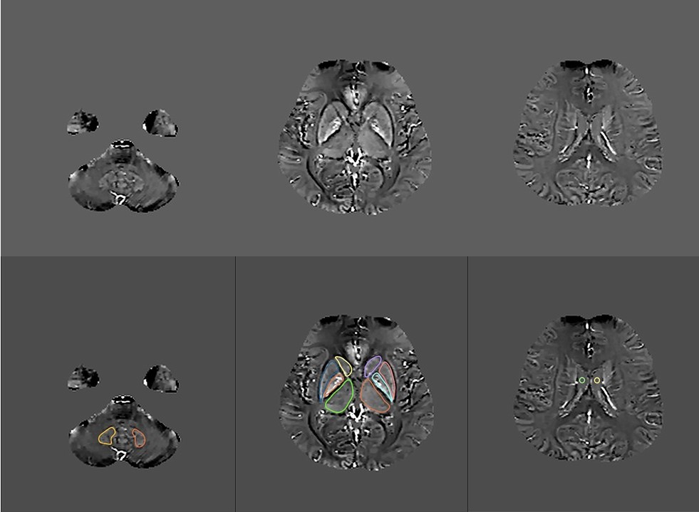 Fig. 1. This imageshows six selected regions of one QSM image slice ...