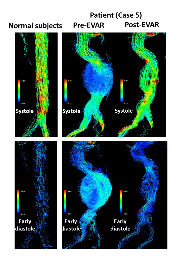 Fig. 1 representative 3D depictions of streamlines in systole and ...