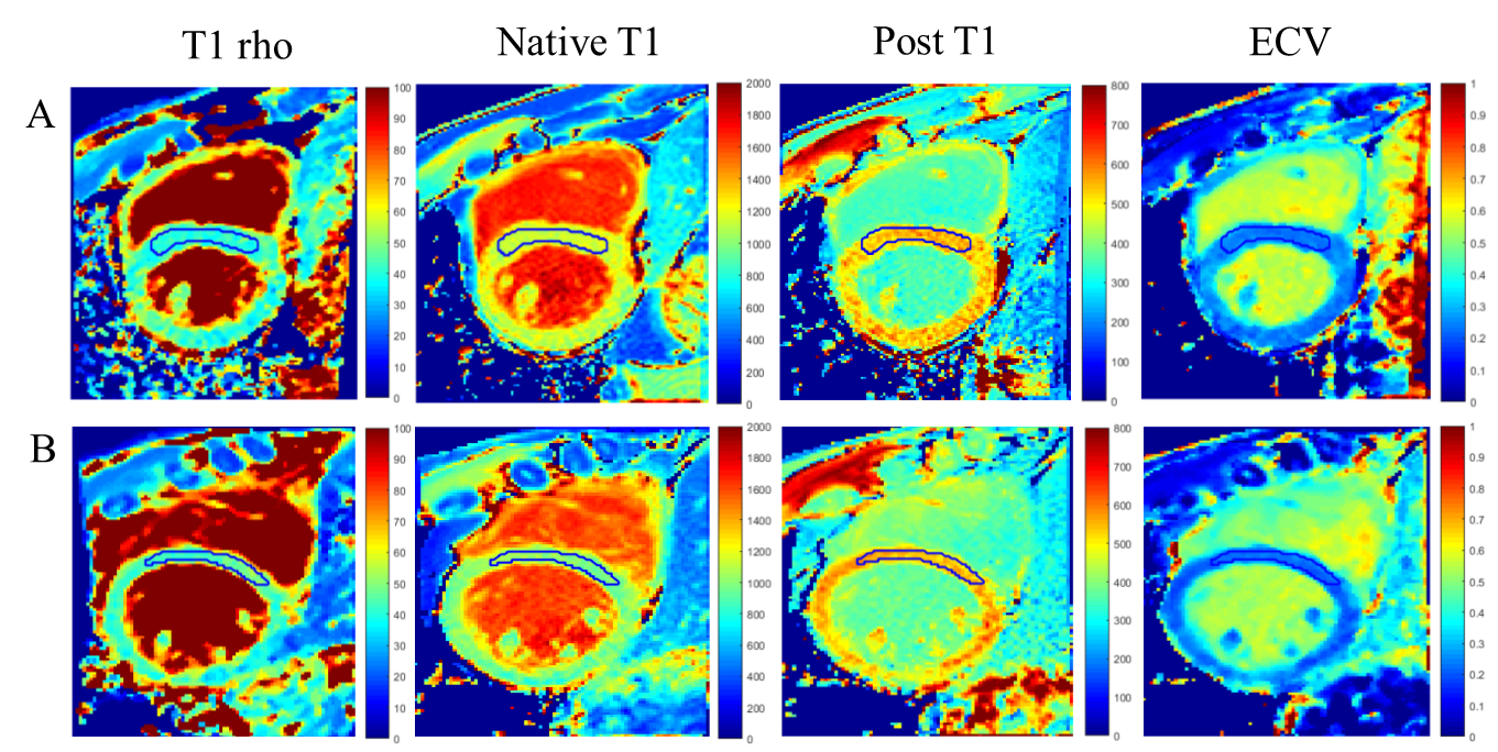 Figure 1. T1 rho andT1 mapping measurements of subjects with and ...