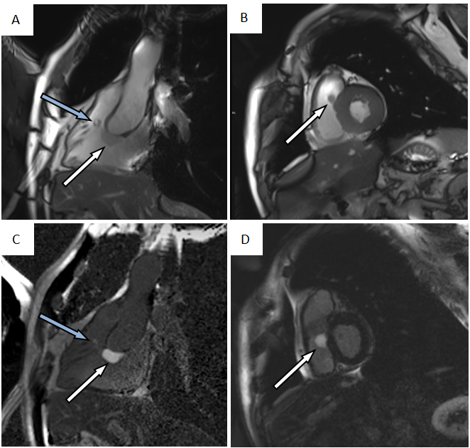 CMR allows a more comprehensive characterization of the cardiac mass ...