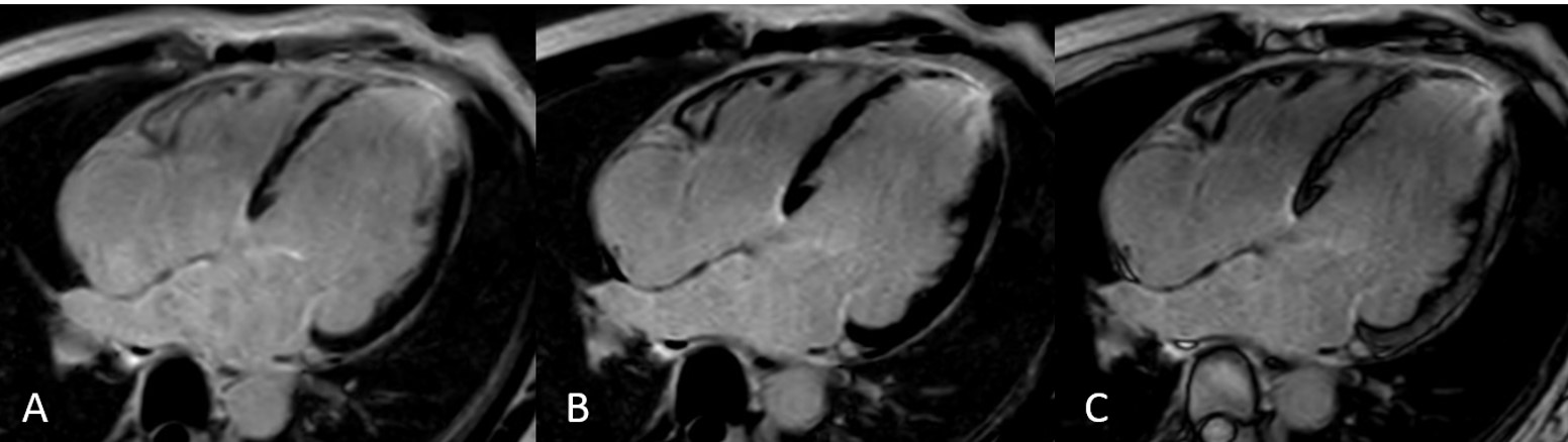Auto TI-IR LGE shows that the image quality is better thanthat of MagIR ...