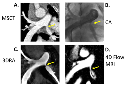 Representativeangiograms from swine with PA stenosis. Arrows indicate ...