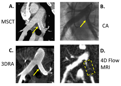 Representativeangiograms from swine with PA stenosis. Arrows indicate ...
