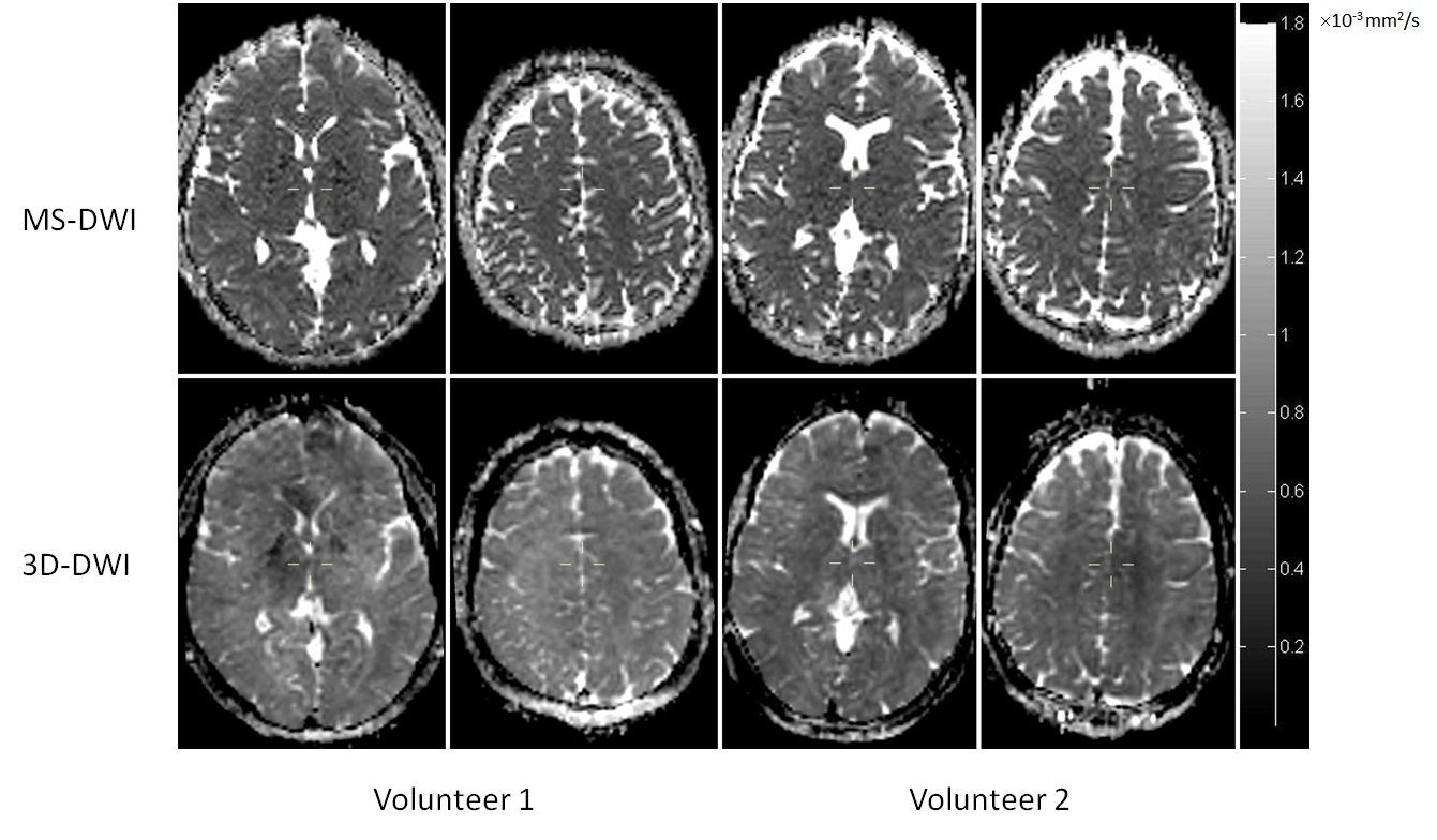 Figure 3: ADC maps of two reformatted slices for two volunteers are shown.