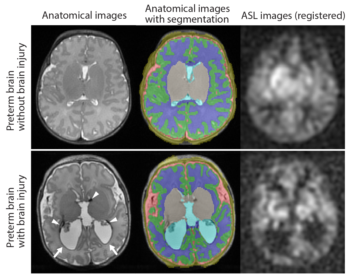 Longitudinal Assessment of Third Trimester Regional Cerebral Blood Flow ...