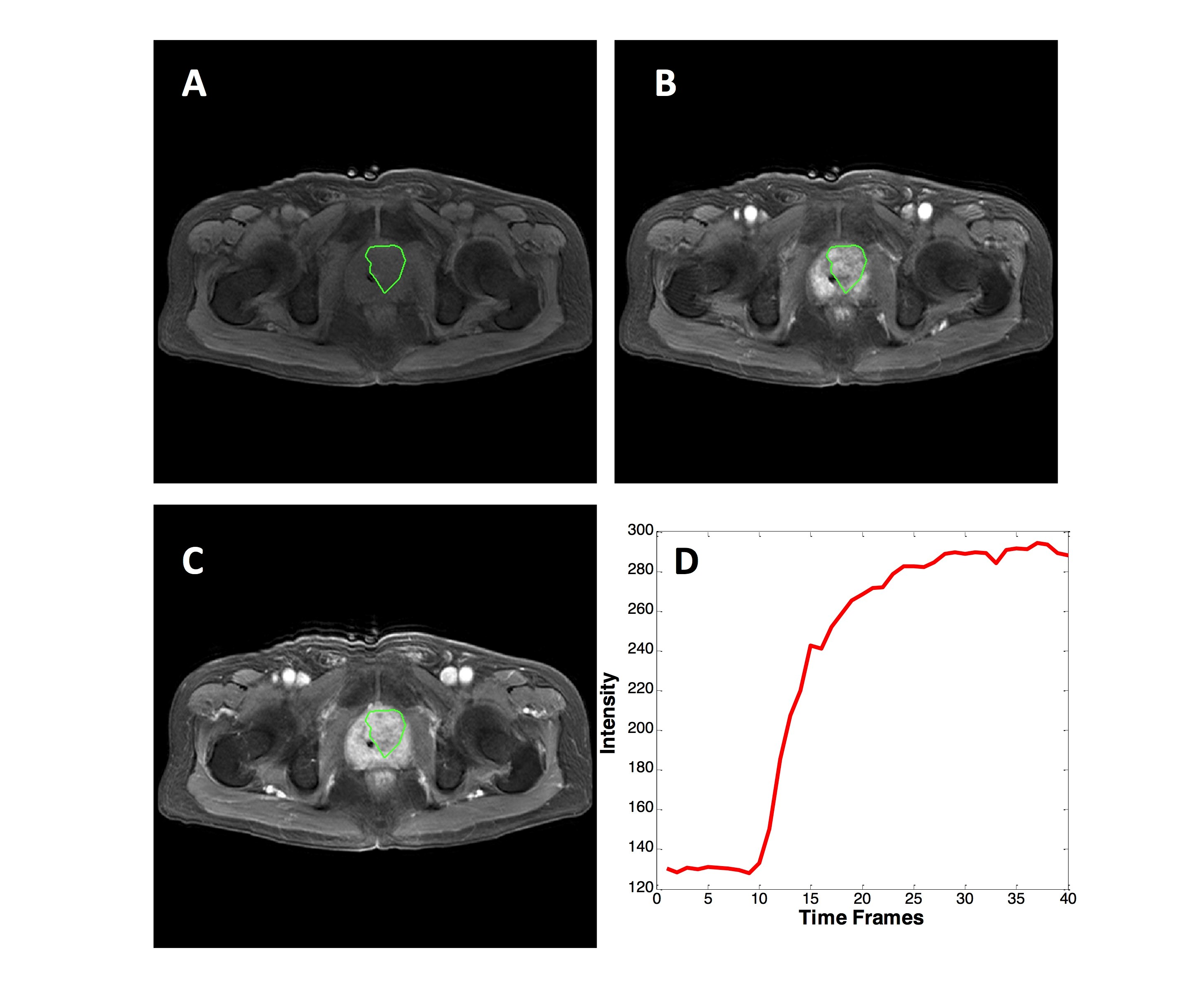Thisstudy demonstrates that machine learning using radiomics and deep ...