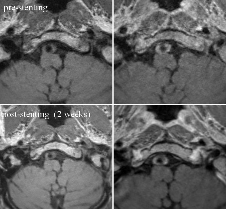 Both the plaquetothalamussignalintensity ratio and plaque/vessel wall ...