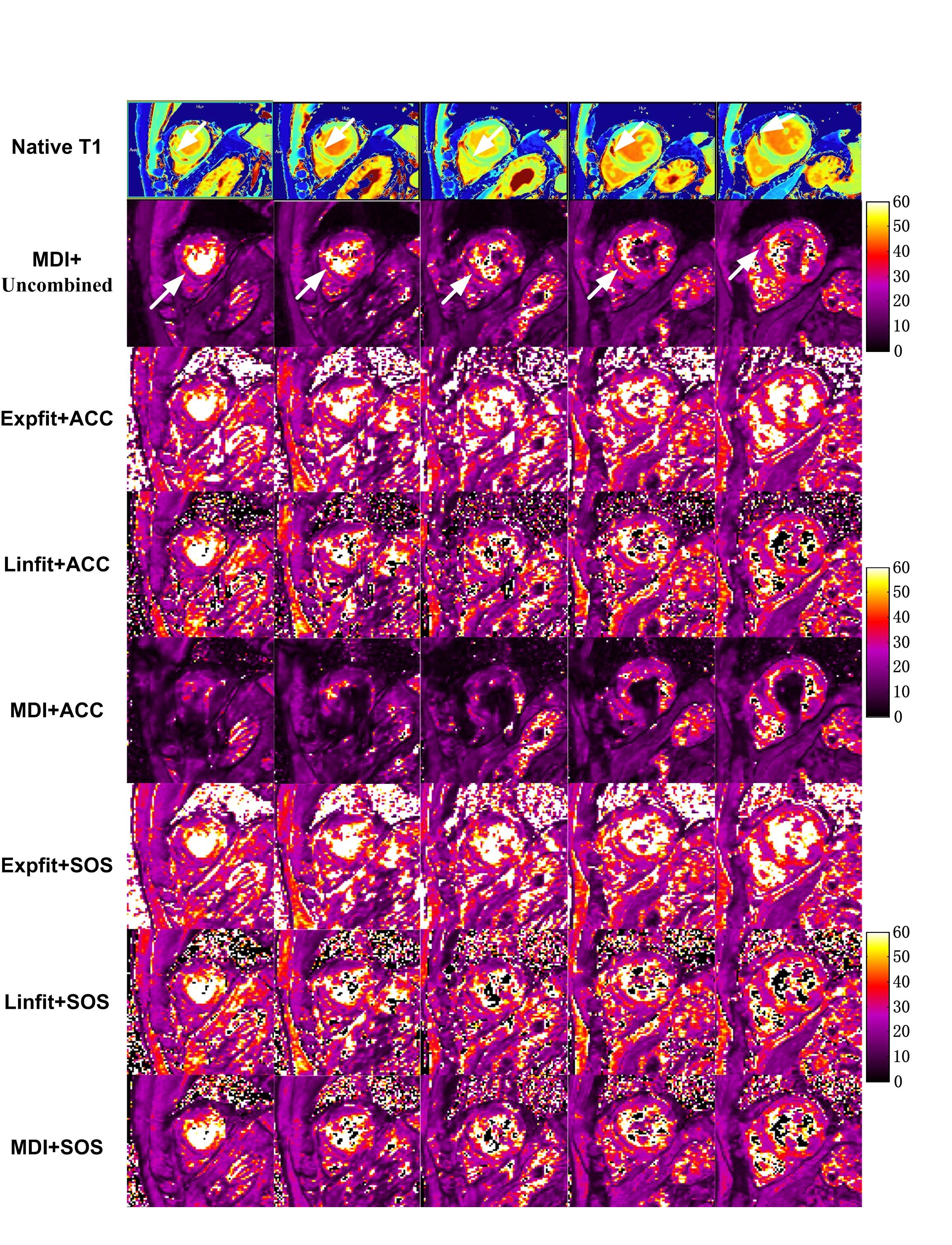 Optimizing Myocardium T2* Mapping using a Novel Multi-Dimension ...