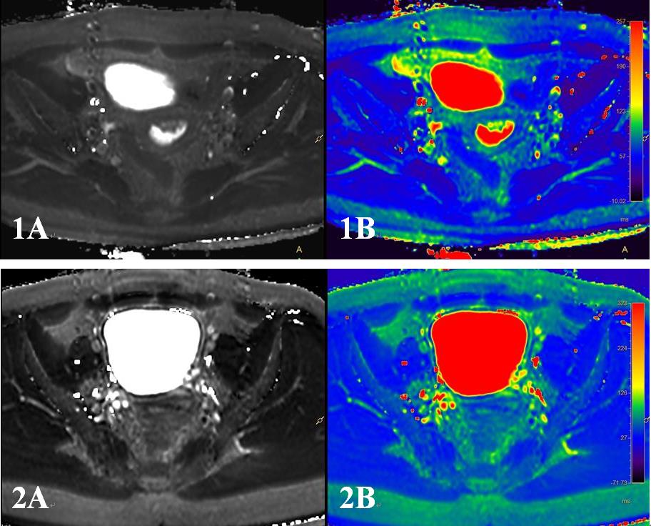 T2 mapping is a novel MRI sequence that enables quantitative assessment ...