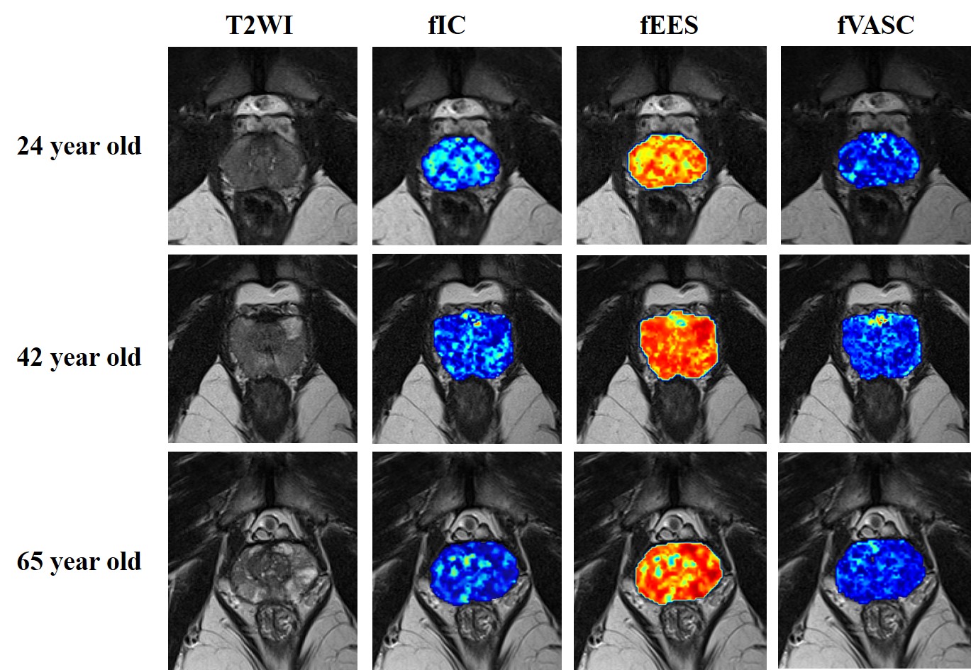 Figure 2: Standard T2image and parametric maps for VERDICT for three ...