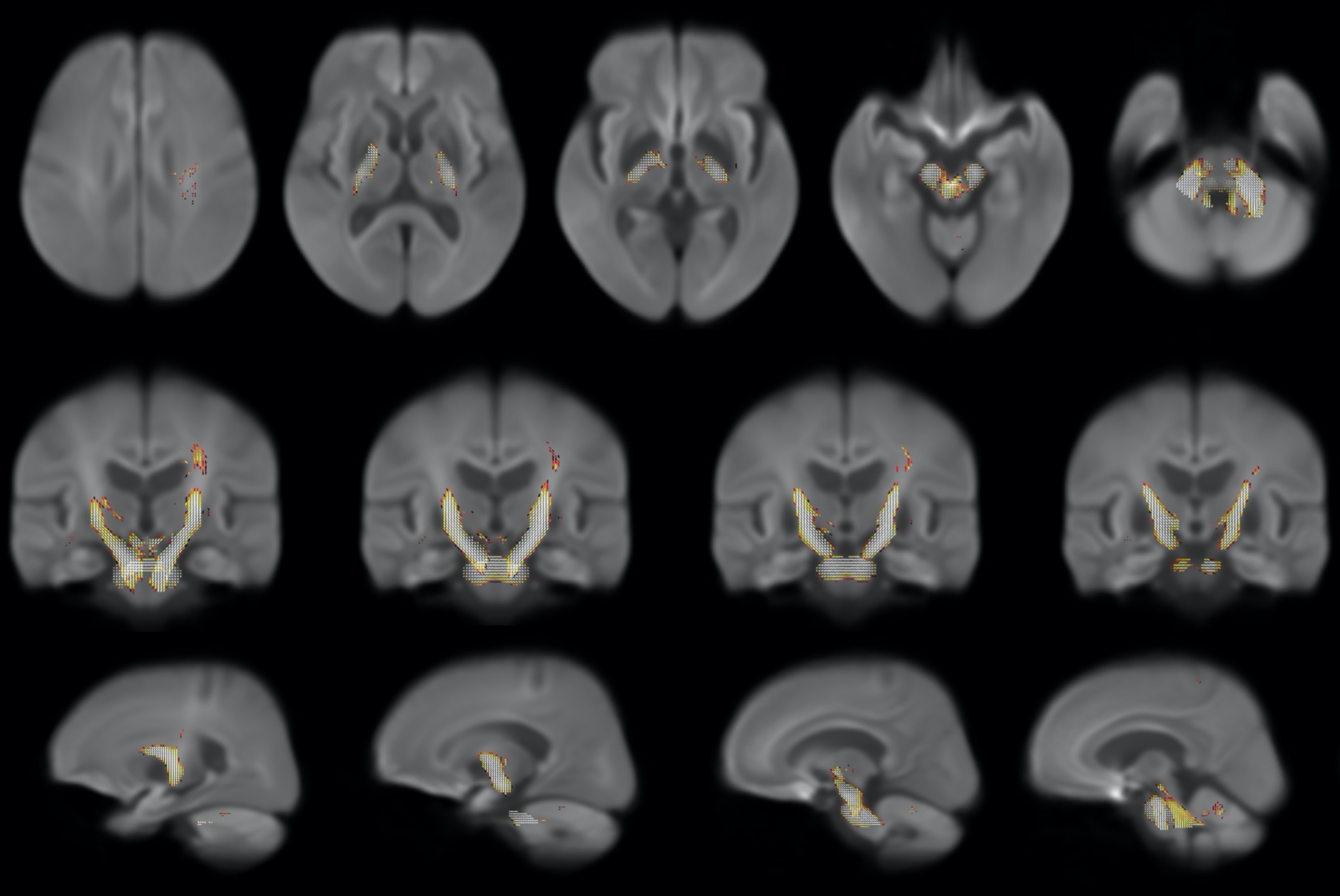 Figure3. FDC changes in MSA compared to that in PD.Reduced FDC in left ...