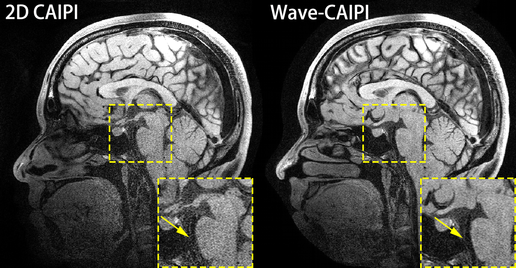 Wave-CAIPI Highly Accelerated Whole-Brain Intracranial Vessel Wall Imaging