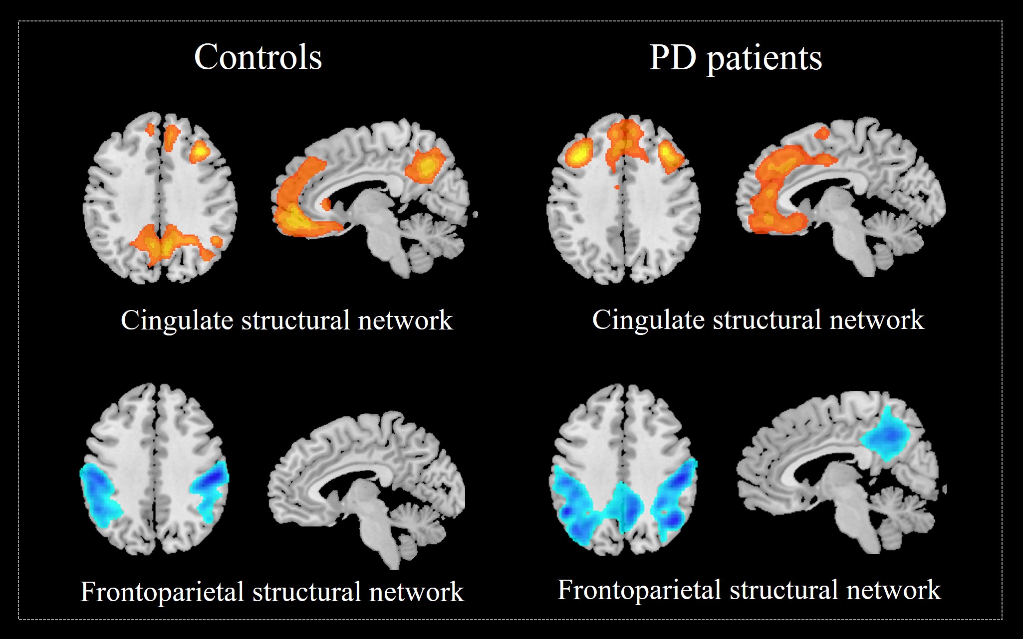 Cingulate structural network display a high susceptibility in PD ...