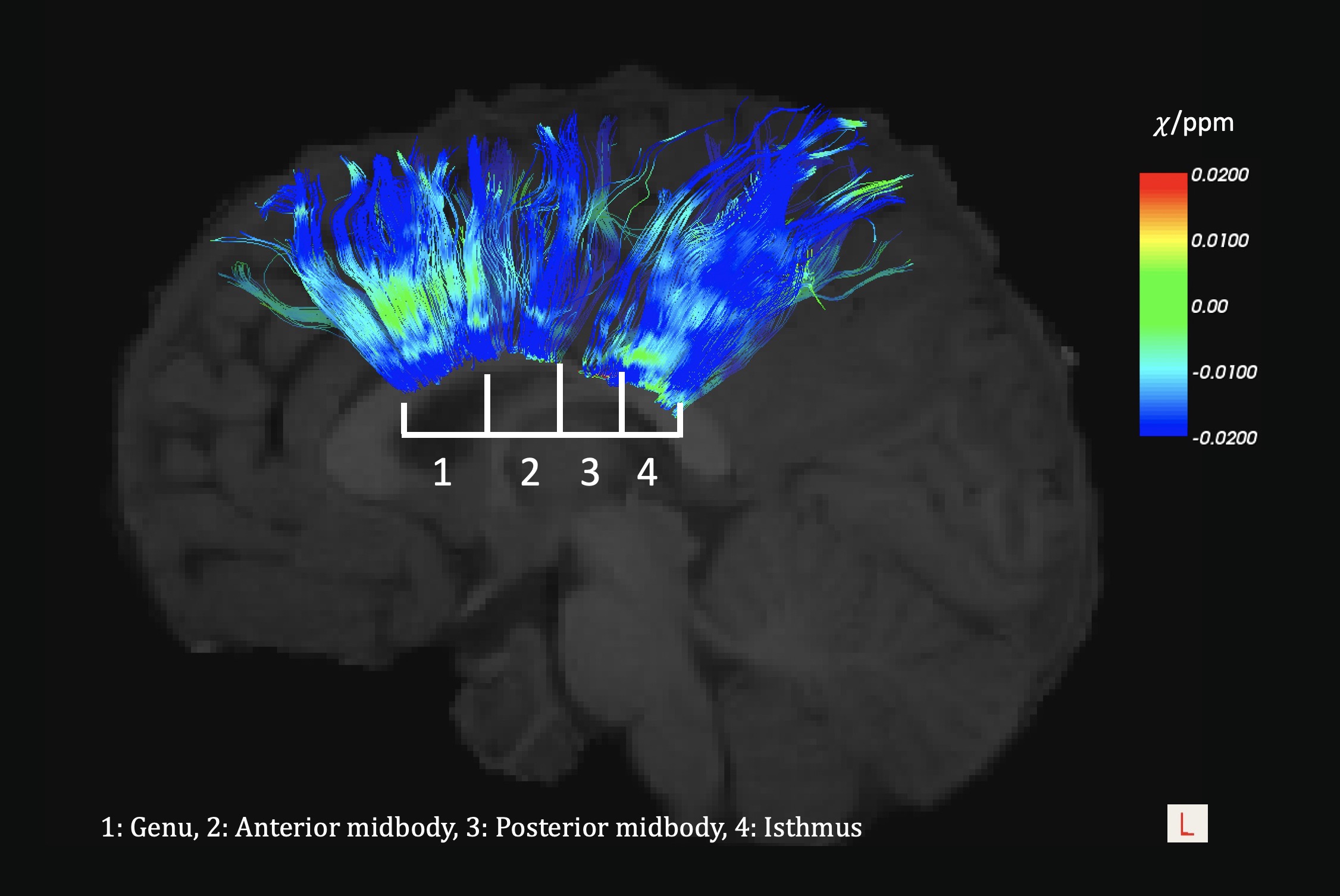 Corpus callosum parcellation with macsroscopic susceptibilityoverlaid ...