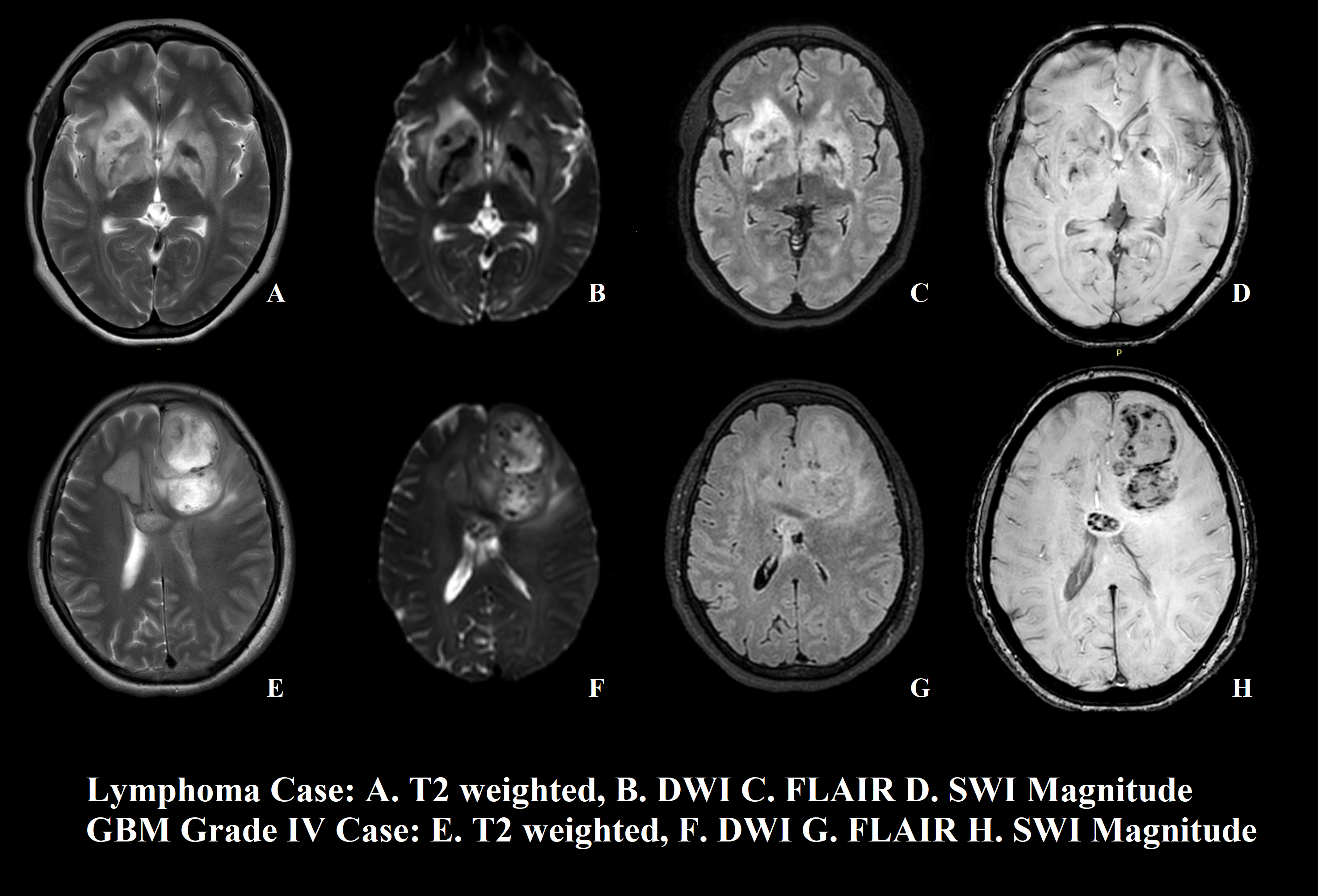 Figure 1: Sample case of Lymphoma (pCNSL) and GBM respectively.