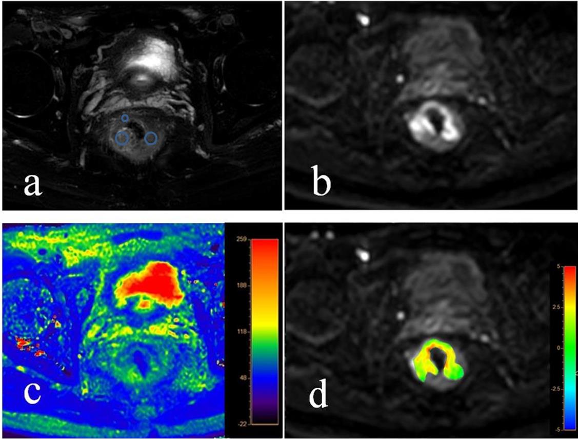 APTw imaging combined with T2 mapping can effectivelyreflect lesion ...