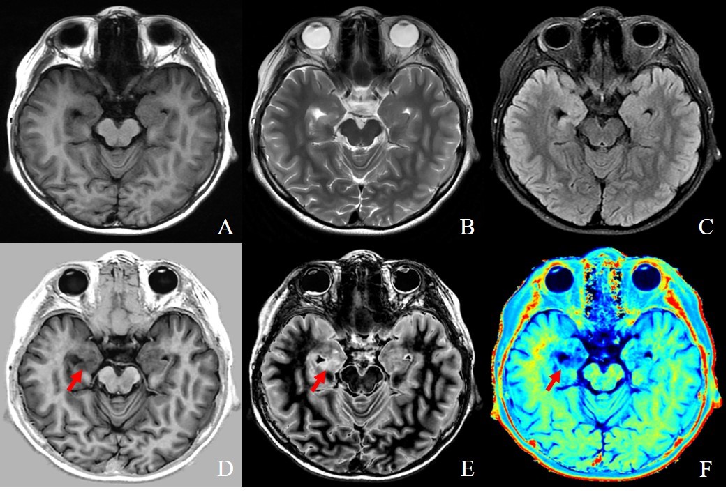 Comparison of conventionalMRI (A ~ C) and synthetic MRI (D~F ...