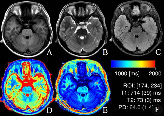 Comparison of conventionalMRI (A ~ C) and synthetic MRI (D~F ...