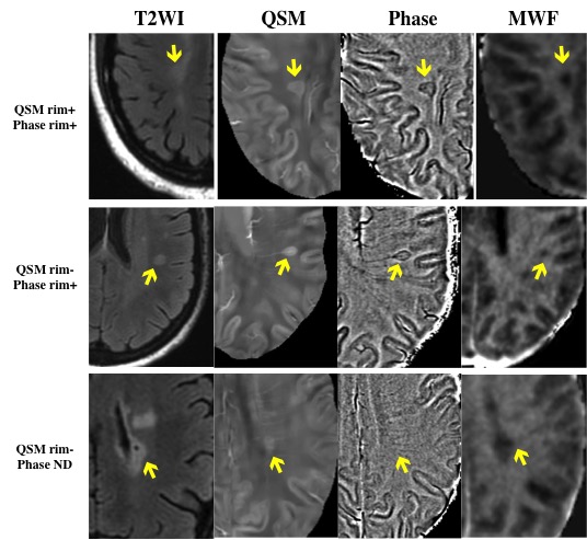 QSM imaging may be more sensitive than phase imaging in detecting ...