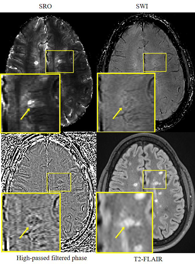 1 Biomedical Engineering, Cornell University, Ithaca, NY, United States ...