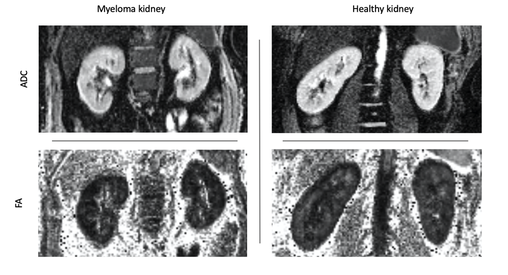 Fig.1: Comparison of diffusionimages (ADC and FA maps) between healthy ...